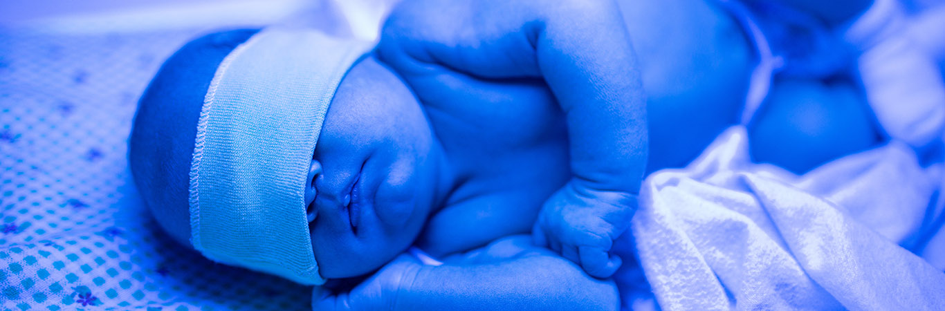 Jaundice in newborn: is it high bilirubin? - Happiest Health