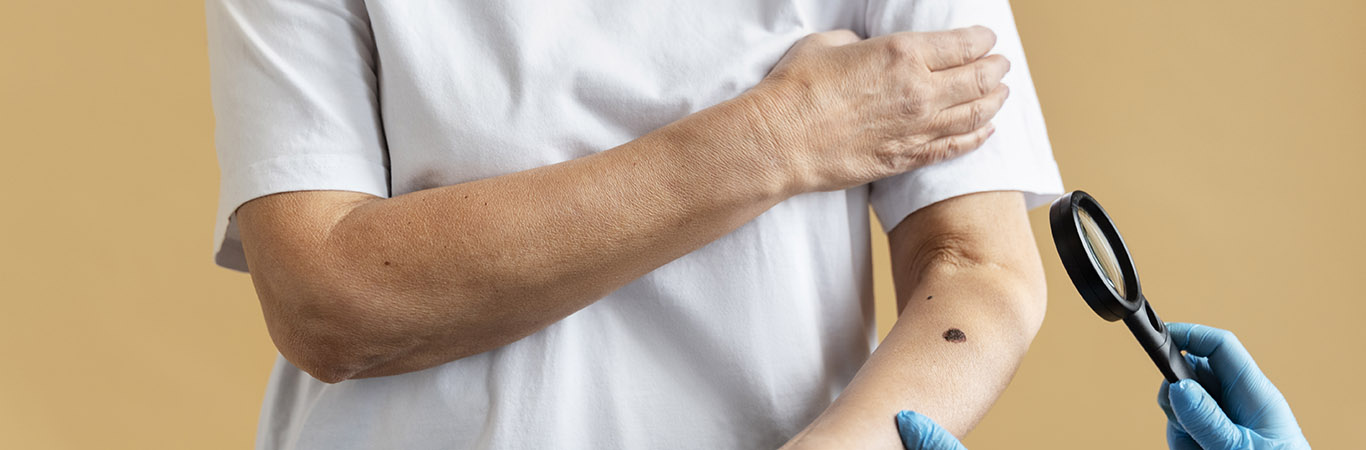 How to deal with senile warts - Happiest Health