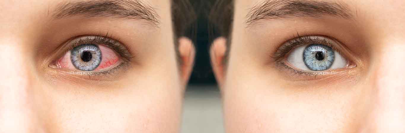 Conjunctivitis? Blame infections (or other people) - Happiest Health