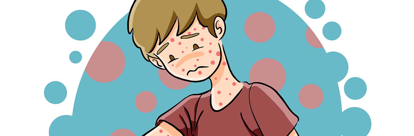 Chickenpox: Managing the symptoms - Happiest Health